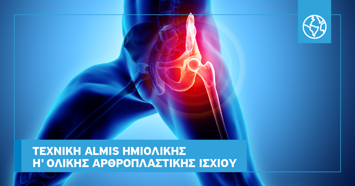Νέα ALMIS τεχνική ημιολικής ή ολικής αρθροπλαστικής ισχίου με μικρά ...